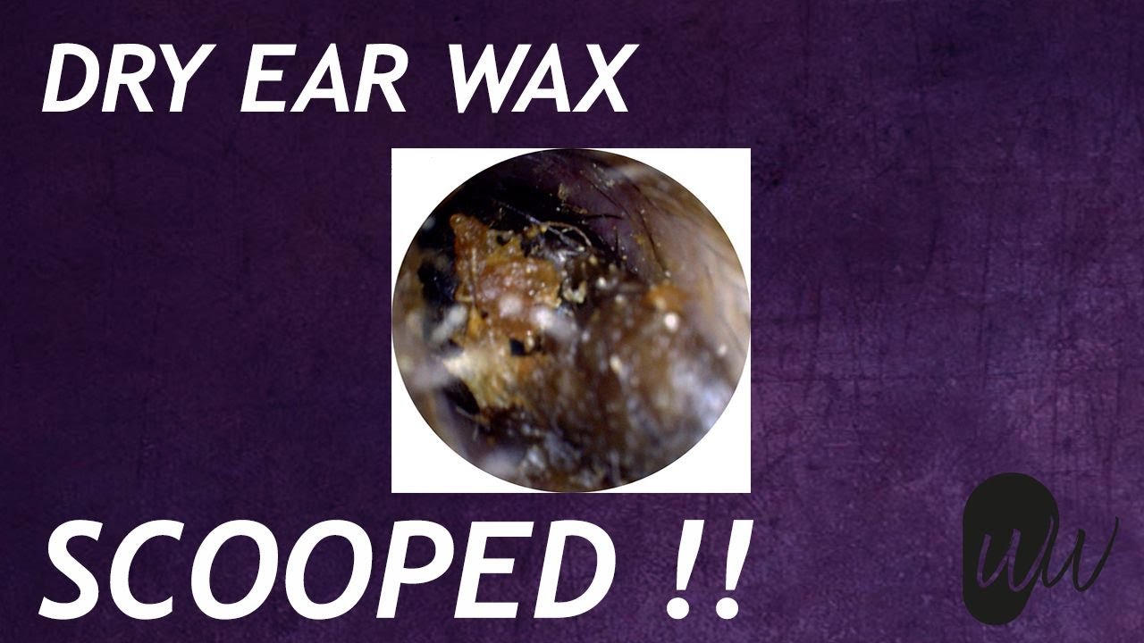 Dry Ear Wax Scooped!! - #358 - YouTube