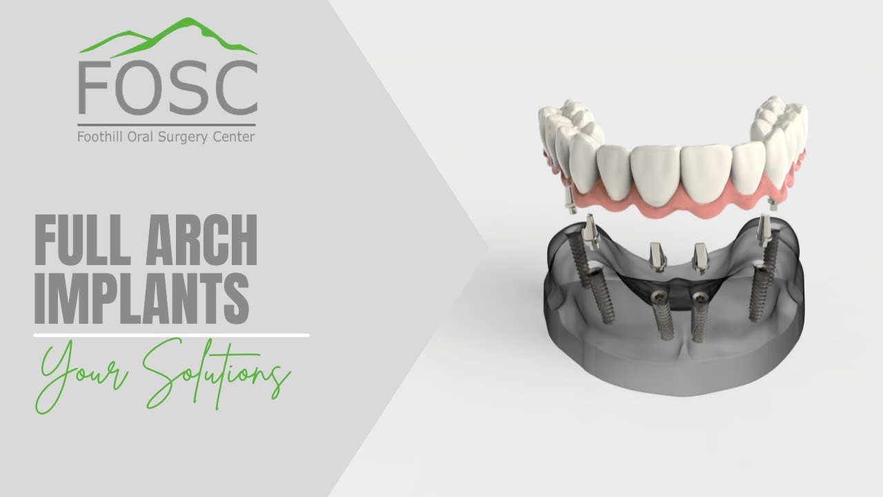 A Full Arch Solution Can Help You Get the Confidence You Need Back ...