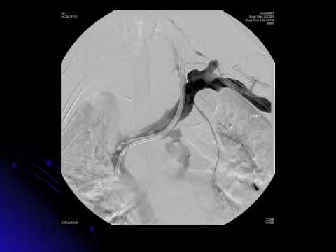 Permacath Change - YouTube