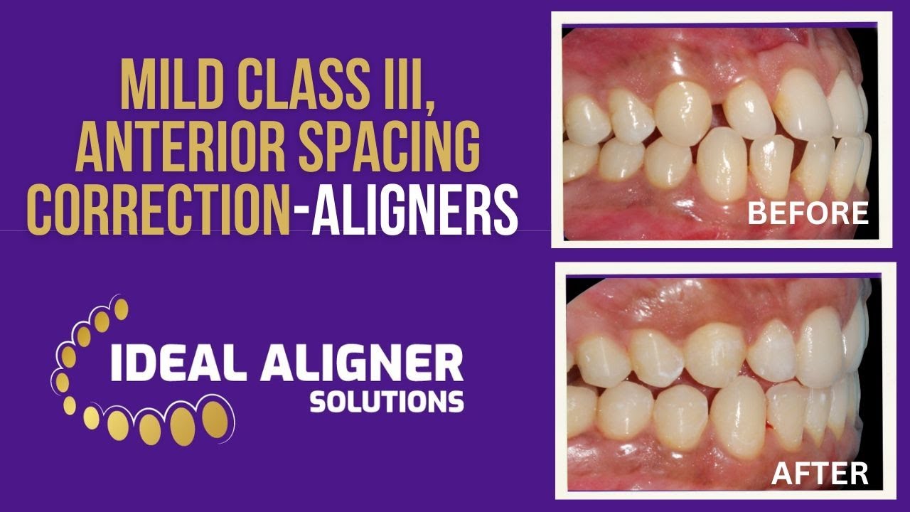 Mild class III and spacing CORRECTION WITH ALIGNERS/IDEAL ALIGNER ...