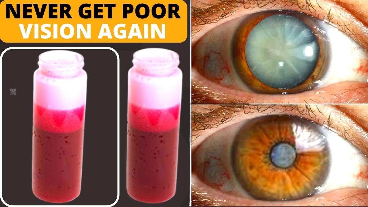 Taking this will ensure clearer vision and the removal of eyeglasses ...