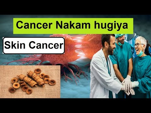 CANCER- Cancer Nakam Hugiya II Garam Anjeer Ka Pani I Skin Cancer I ...