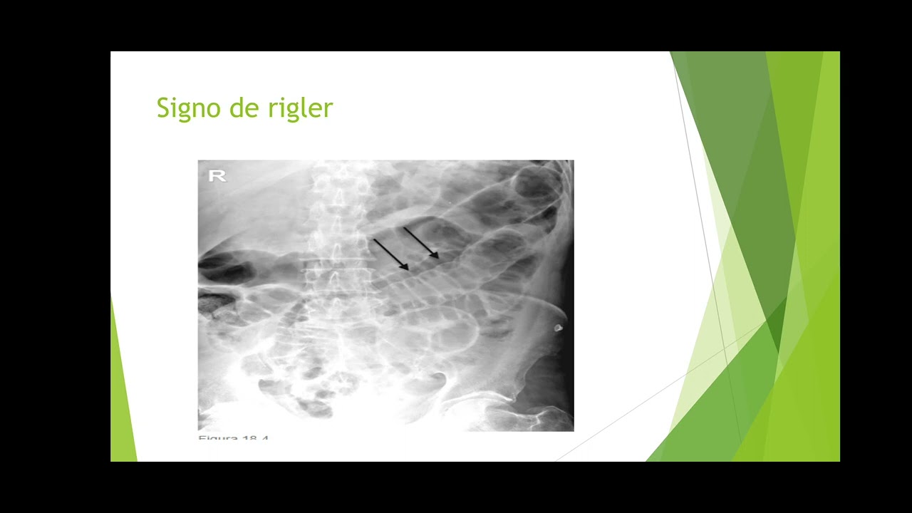 Signos radiológicos del neumoperitoneo y hemoperitoneo - YouTube