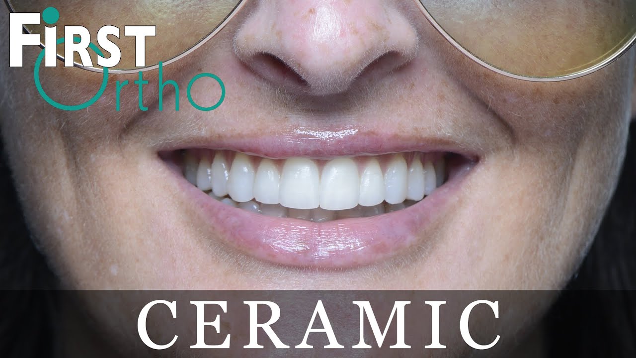 FIRST Ortho - Ceramic Braces - YouTube
