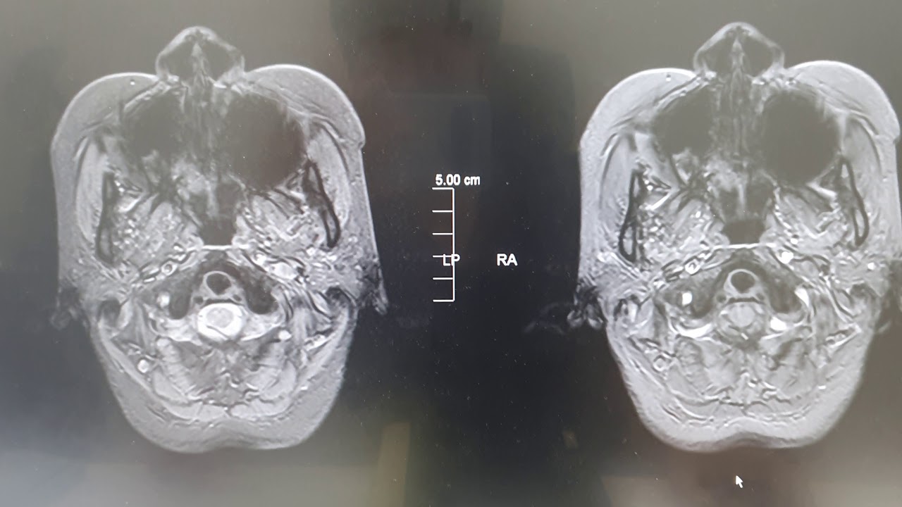 brain mri GRE - YouTube