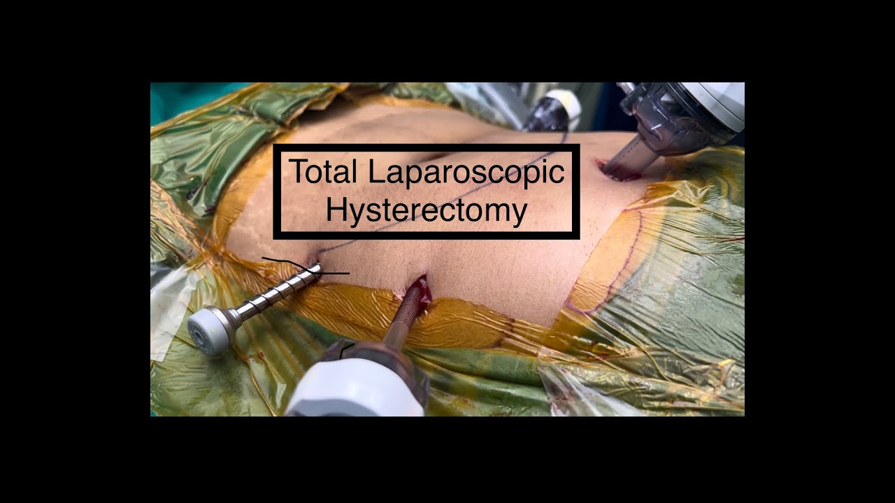 Total Laparoscopic Hysterectomy with Extensive Adhesions - YouTube