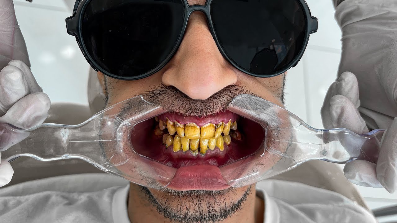Deep Teeth Cleaning To A Brilliant Shine! First Time Tartar Removal 30 ...