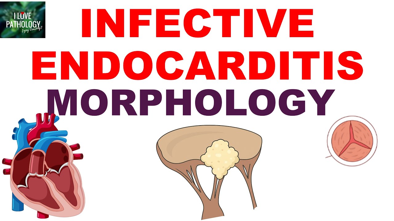 Infective Endocarditis Signs