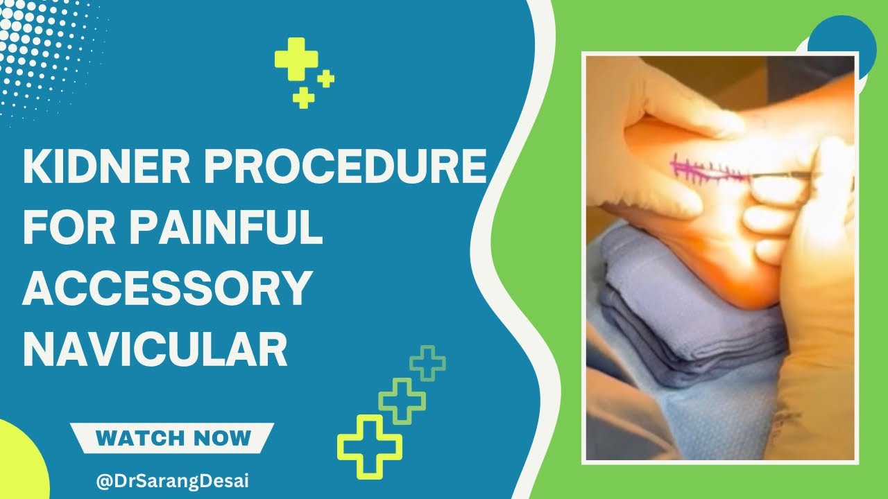 Kidner Procedure for Painful Accessory Navicular - YouTube