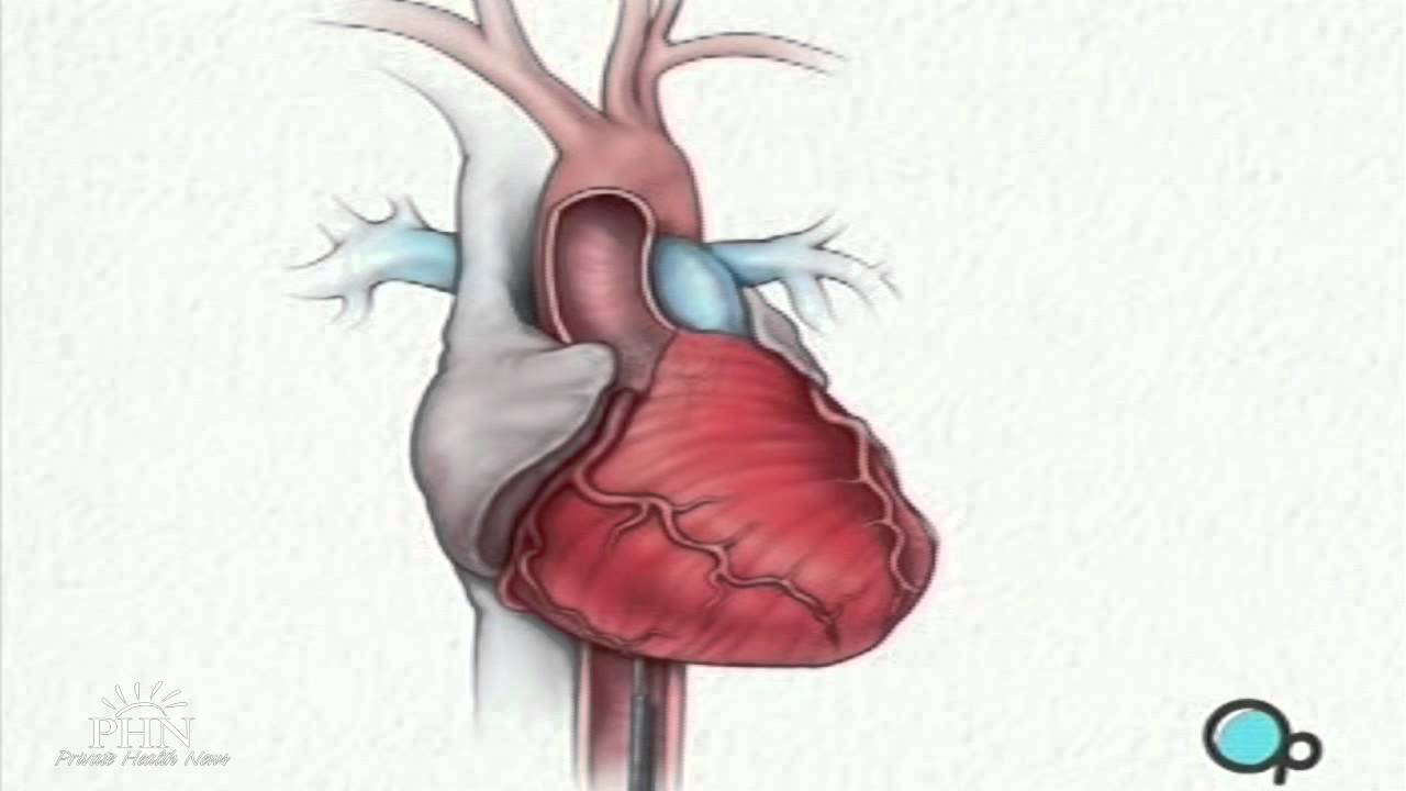 Balloon Angioplasty Coronary Angioplasty Surgery - YouTube