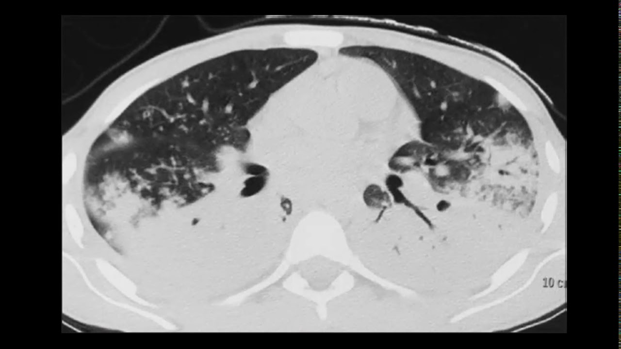 010 Remote E- radiology Learning : Case Based CT Patterns of Lung ...