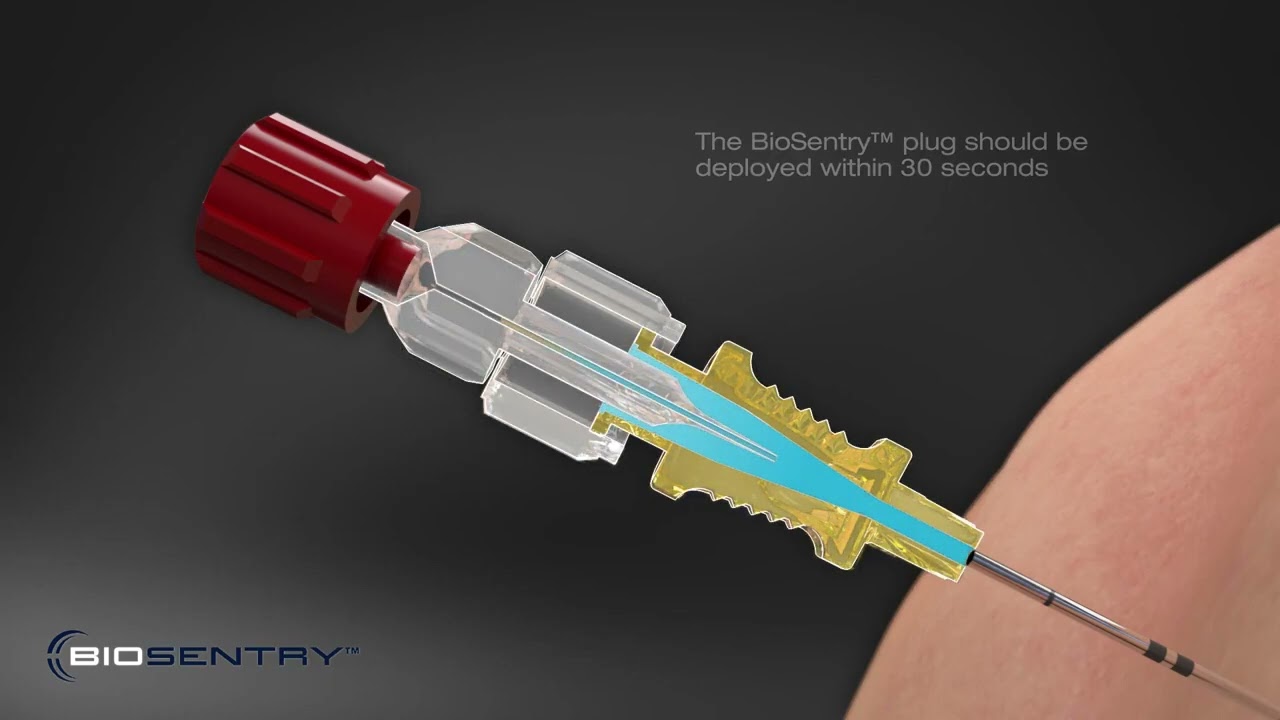 BioSentry Tract Sealant System - YouTube