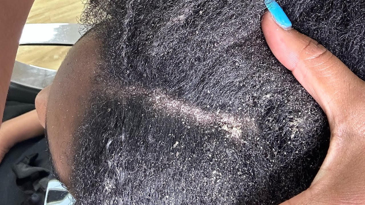 ASMR-Dandruff scratch and result - YouTube