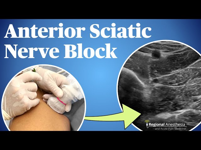 Sciatic Nerve Block Ultrasound