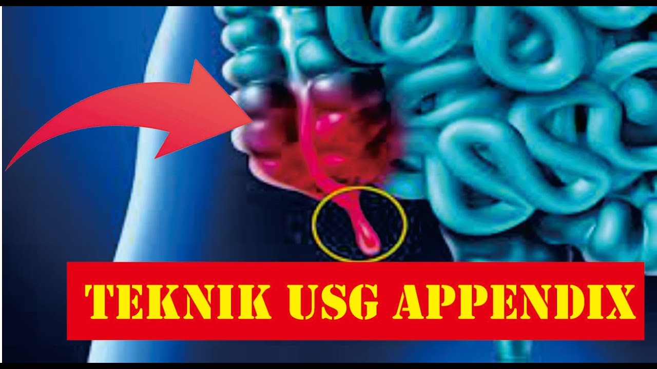TEKNIK USG APPENDIX - YouTube
