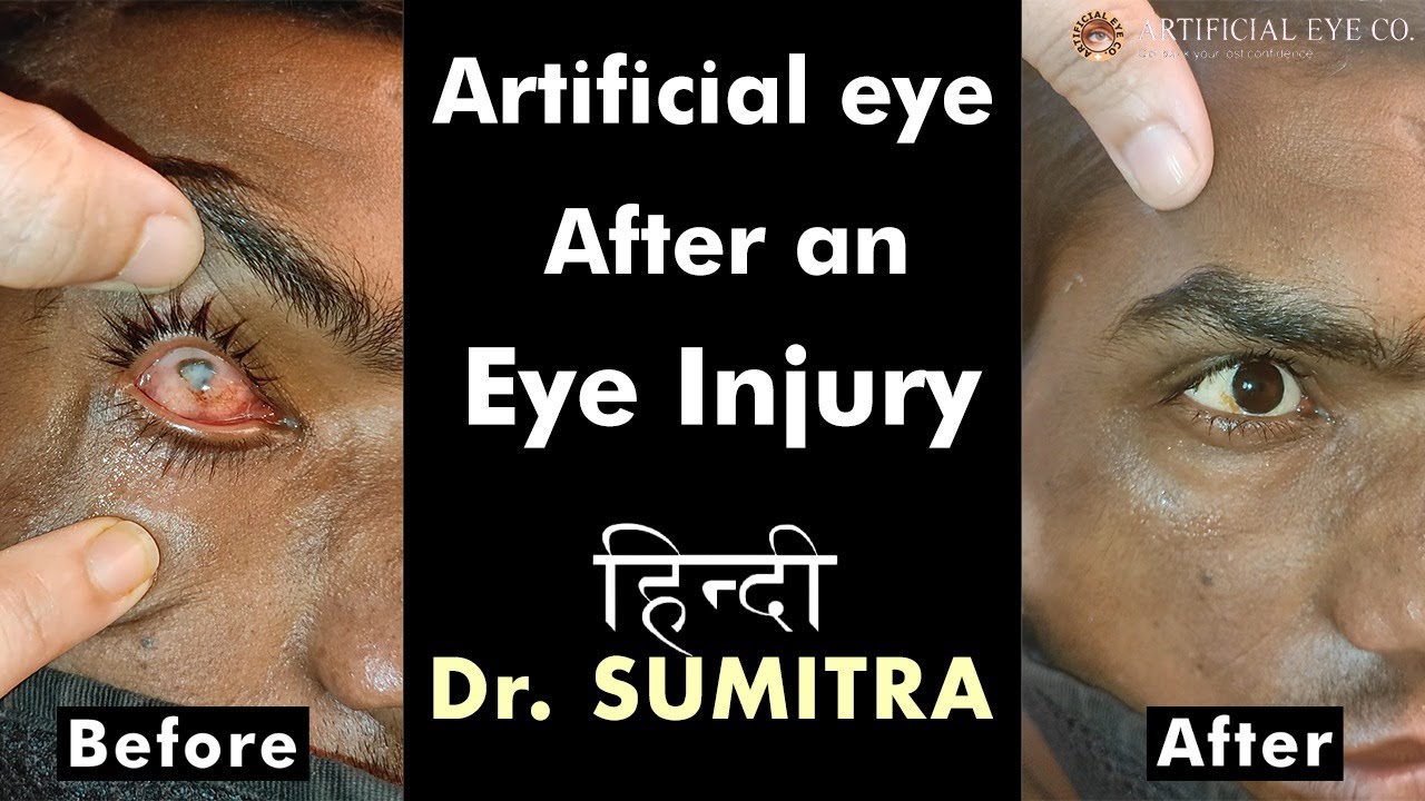 Artificial eye for Eye loss in an eye injury | Ocular prosthetics | Dr ...
