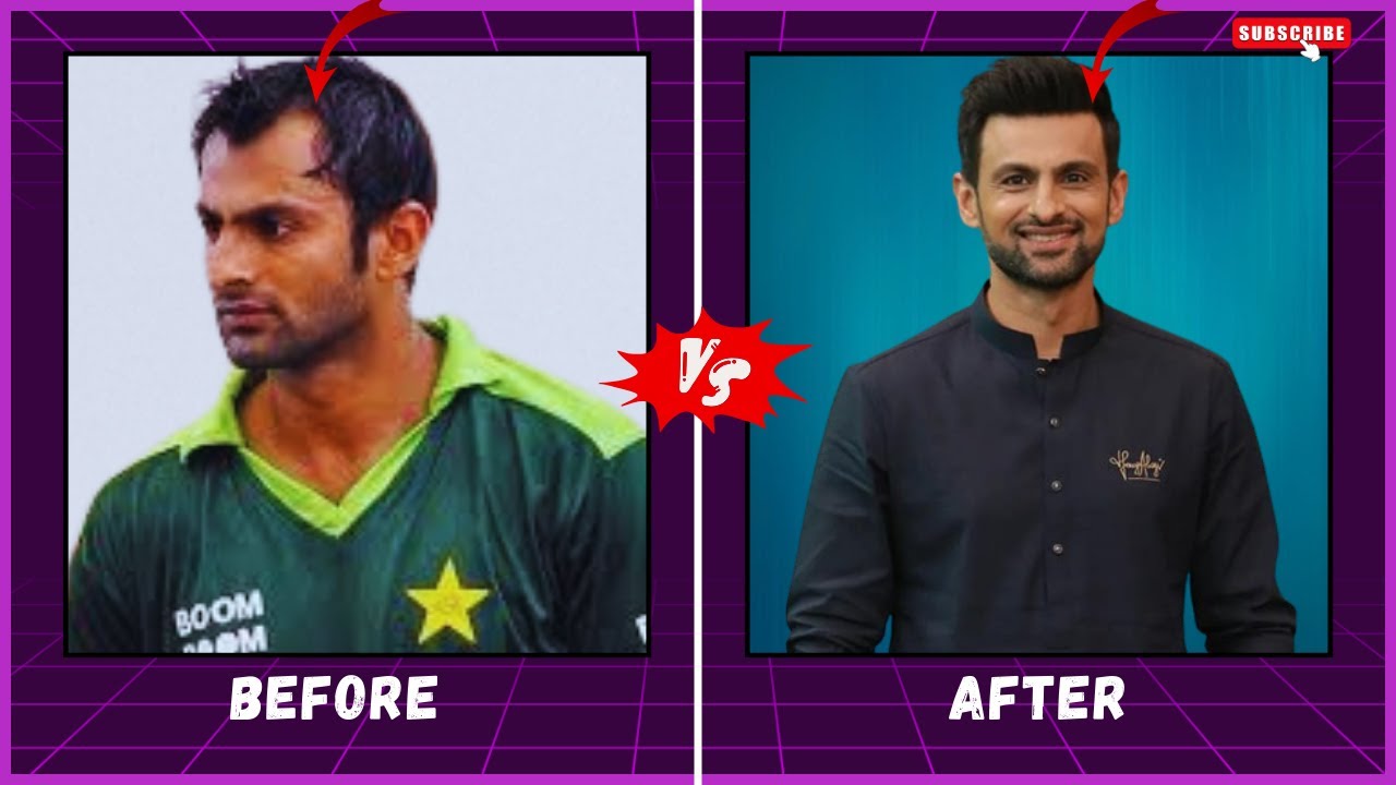 Before and After: Hair Transplant Transformations of Cricketers | Cric ...