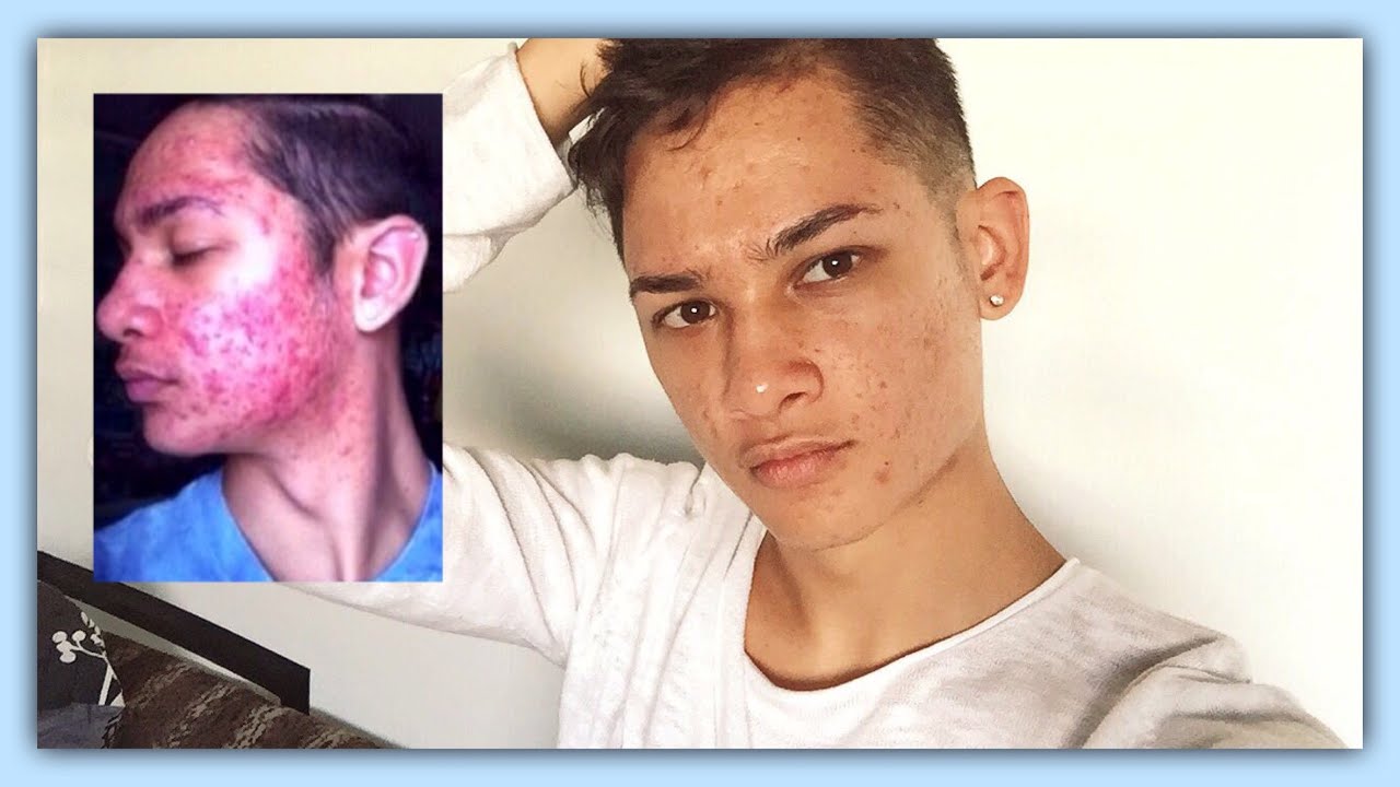 My Acne Update Youtube
