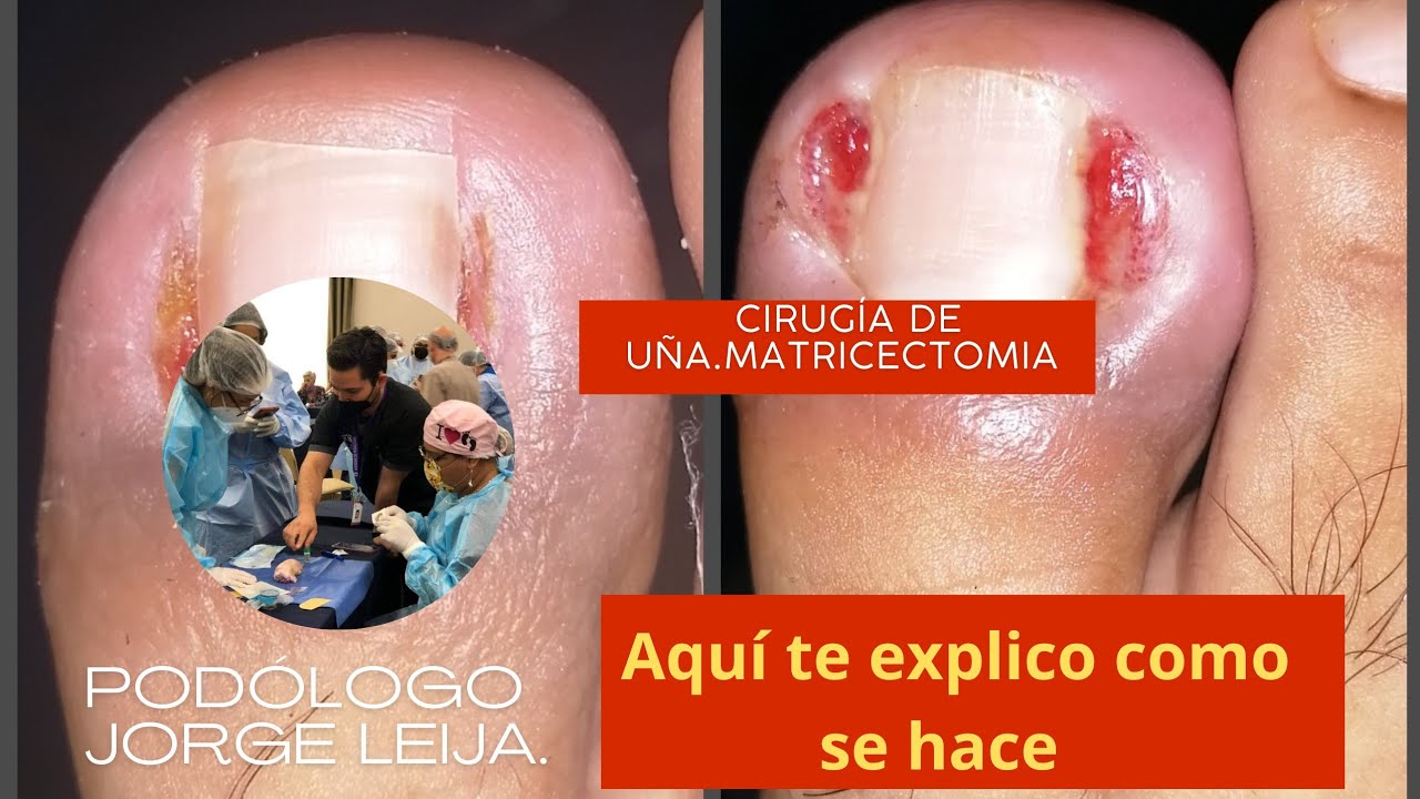 🇲🇽🦶🏼Cirugía de la uña (matricectomia) explicado. 🦶🏼 - YouTube