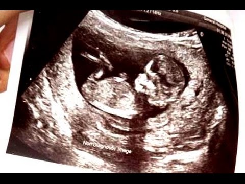 Pro Life Ultrasound On the Road With Shari Richard Speaker YouTube ...
