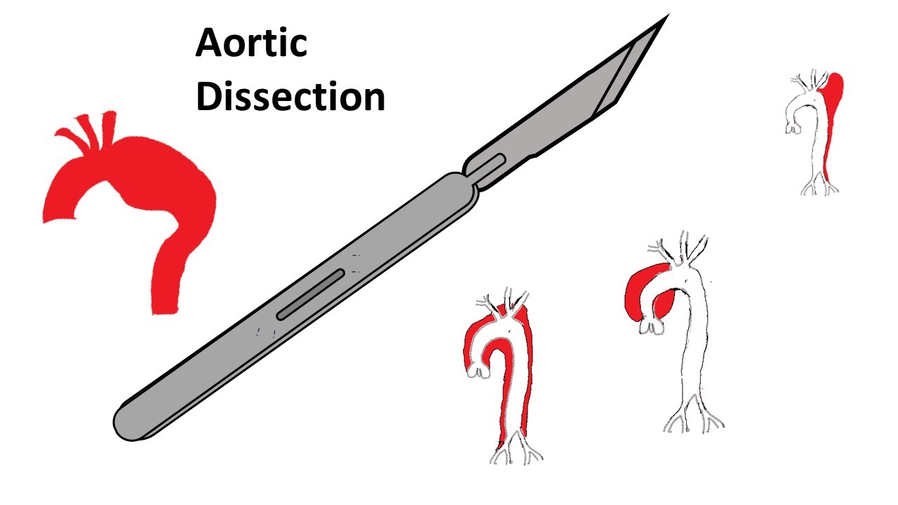 AORTIC DISSECTION : Definition Etiology Pathogenesis Morphology ...
