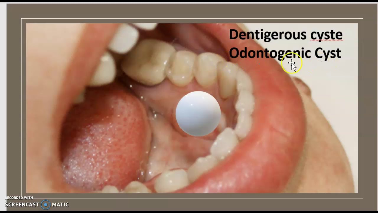 Medicine in 3 minutes (RANULA/ DENTIGEROUS CYST/ BRANCHIAL CYST/ TORUS ...