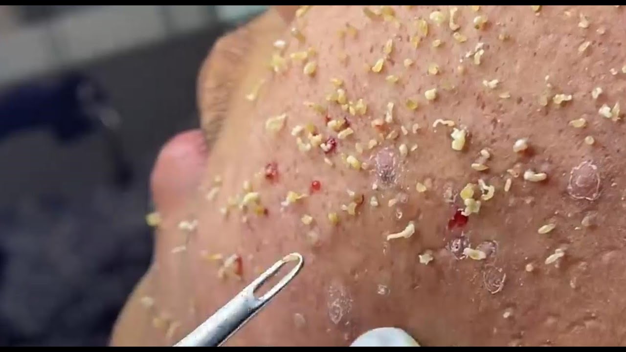 Super Satisfying Blackhead Removal With Skill - YouTube