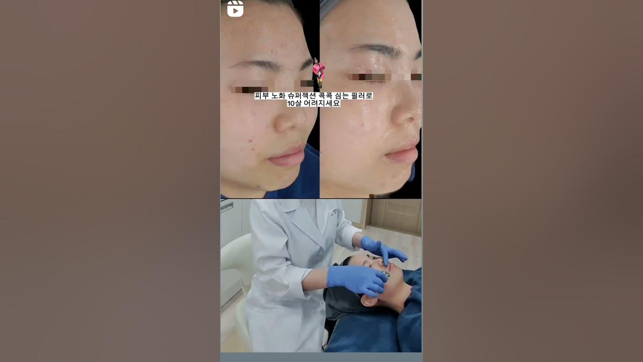 거제피부 여드름 Skincare 좁쌀여드름 피부관리 Beauty Cosmetics 슈펙트 세멘시트 Acne 슈퍼젝션 슈펙트 여드름교육 Youtube