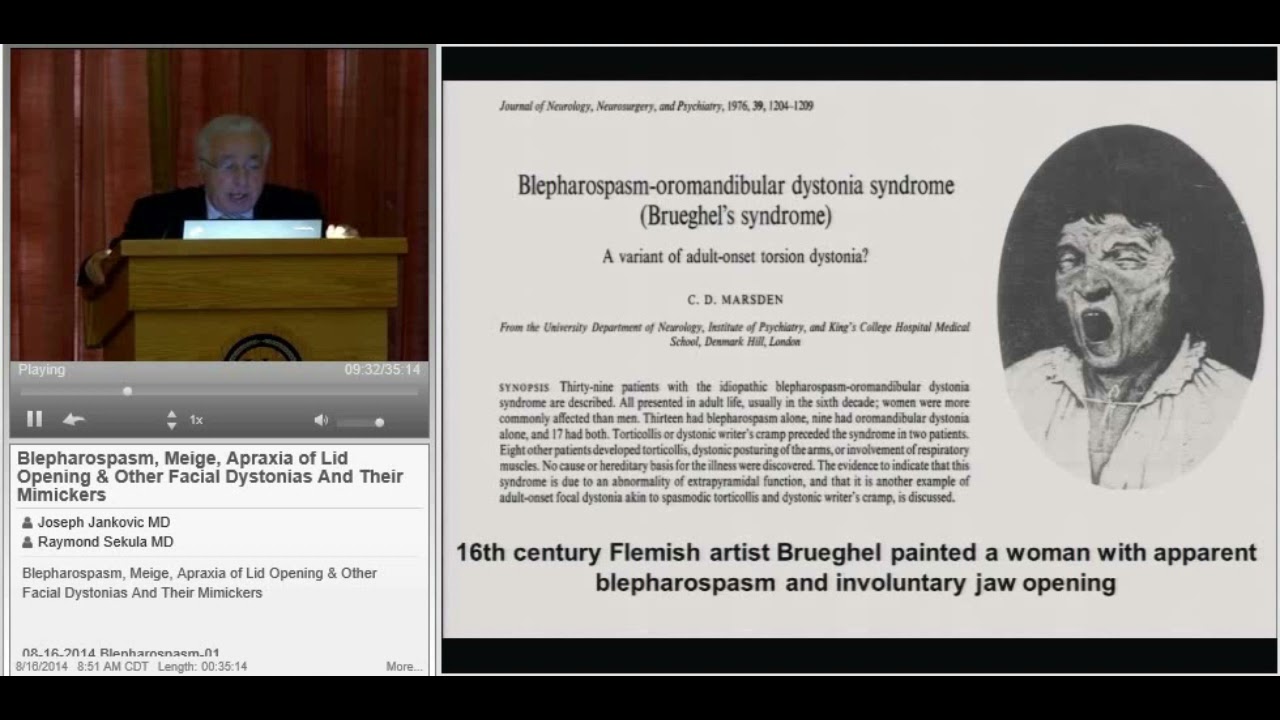 Blepharospasm, Meige, Apraxia of Lid Opening & Other Facial Dystonias ...