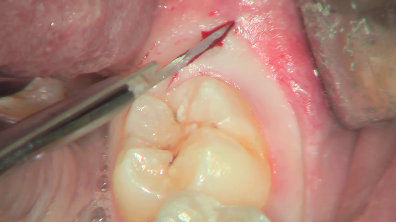 Incisions for the removal of an impacted lower left 3rd molar (case 1 ...