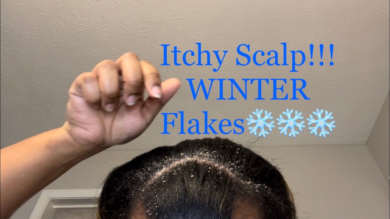 Dandruff Scratching!!! Picking Winter Dandruff Flakes | Winter Itch ...