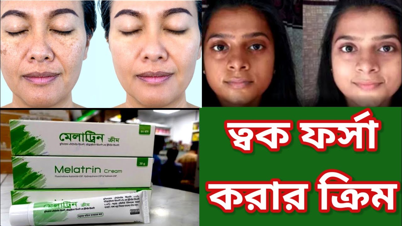 Melatrin cream uses.মেলাট্রিন ক্রিম এর ব্যাবহার। মেছতা দূর করার ক্রিম ...