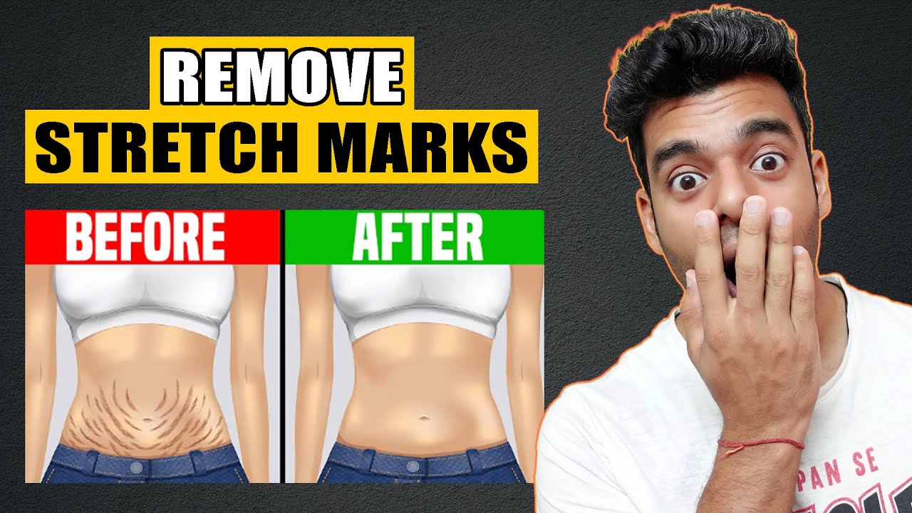 How to Remove Stretch Marks Permanently | Nikhil Nautiyal Fitness - YouTube