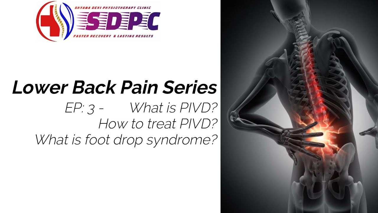 Ep: 3: What is PIVD? | Lower Back Pain Series #physiotherapyindia #SDPC ...