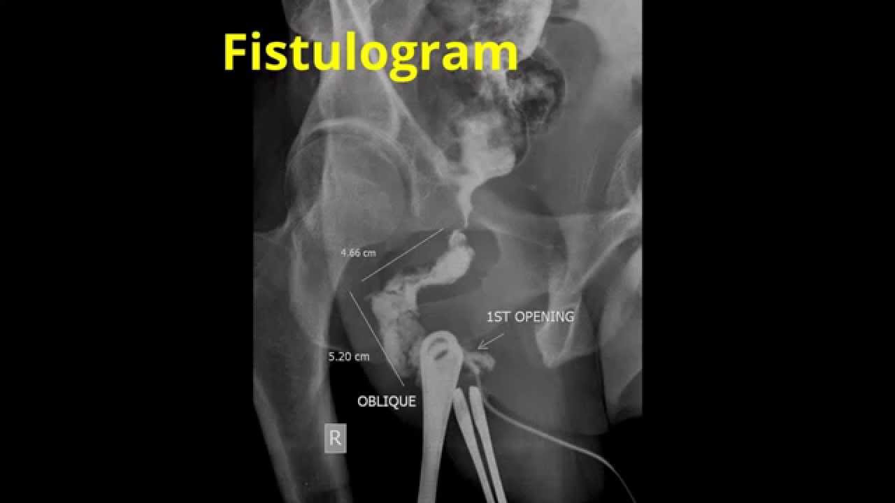 Complex Fistula Permanent Cure - YouTube