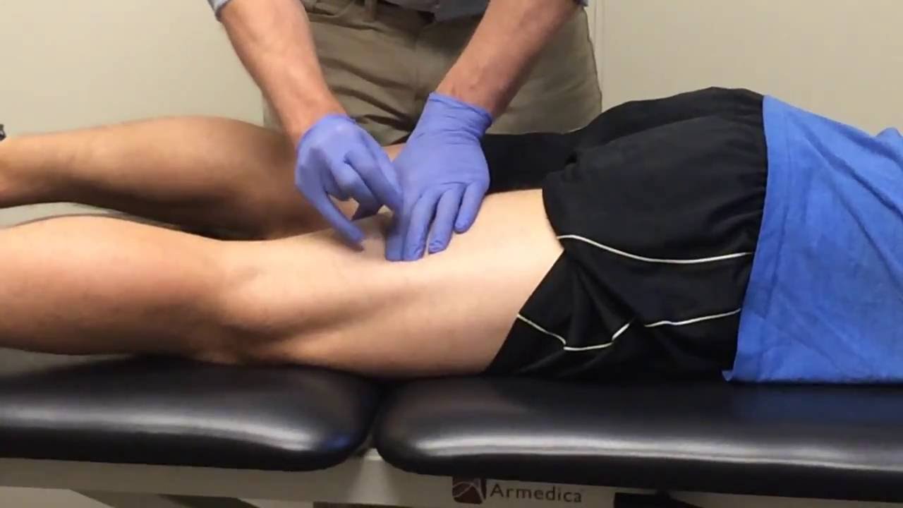 Dry Needling Hamstring - YouTube