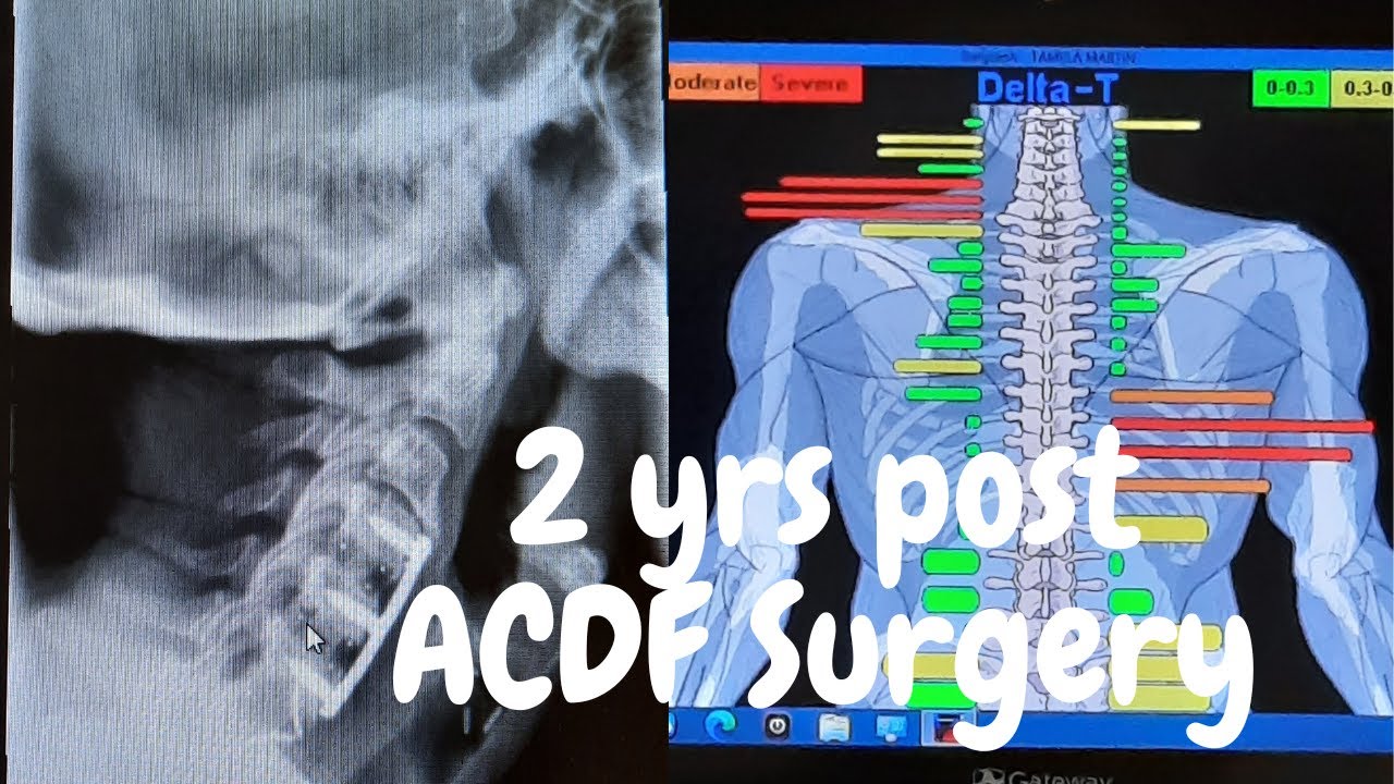 ACDF NECK SURGERY | 2 year post op neck surgery | #acdf, #surgery, # ...