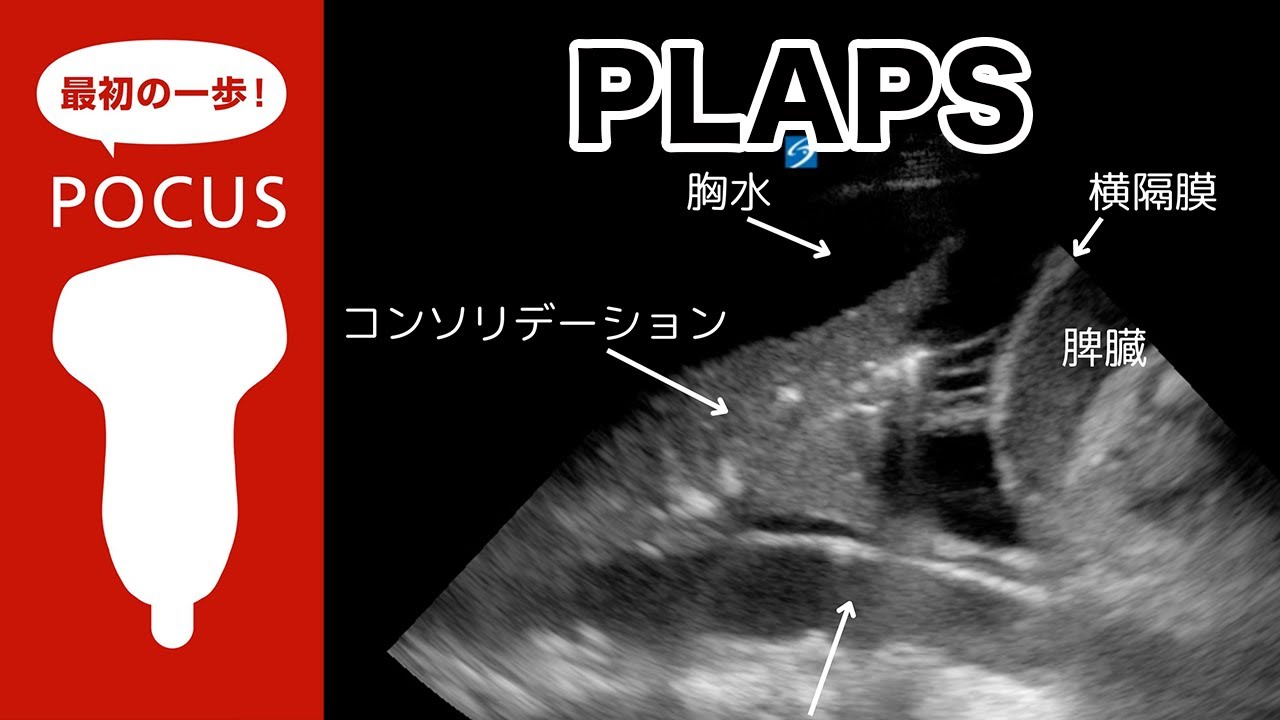 PLAPS【POCUS・肺超音波】 - YouTube