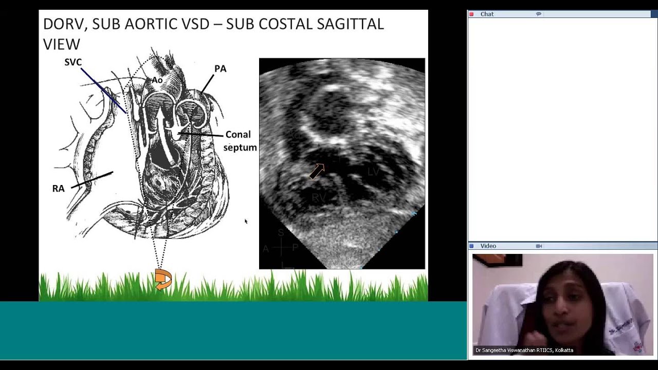 DORV types_echo by Dr Sangeetha-20121127 1159-1 - YouTube