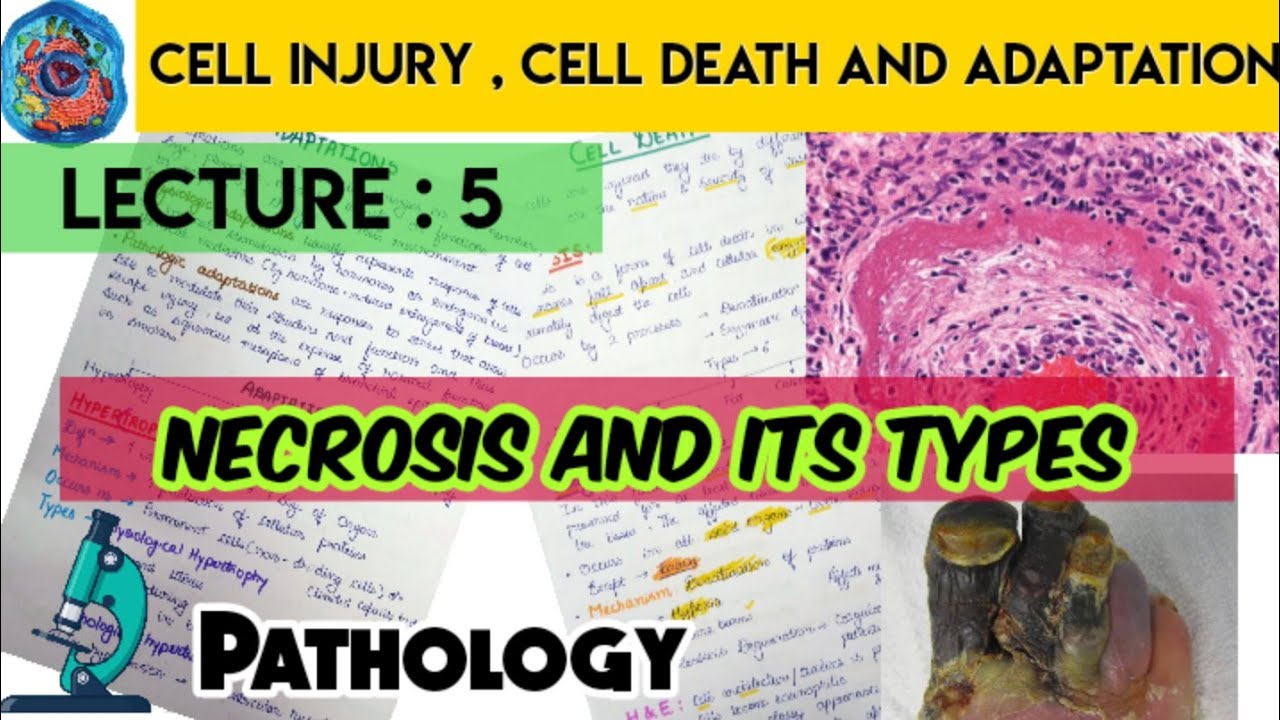 Necrosis | cell death cell injury and adaptation | Robbins pathology ...