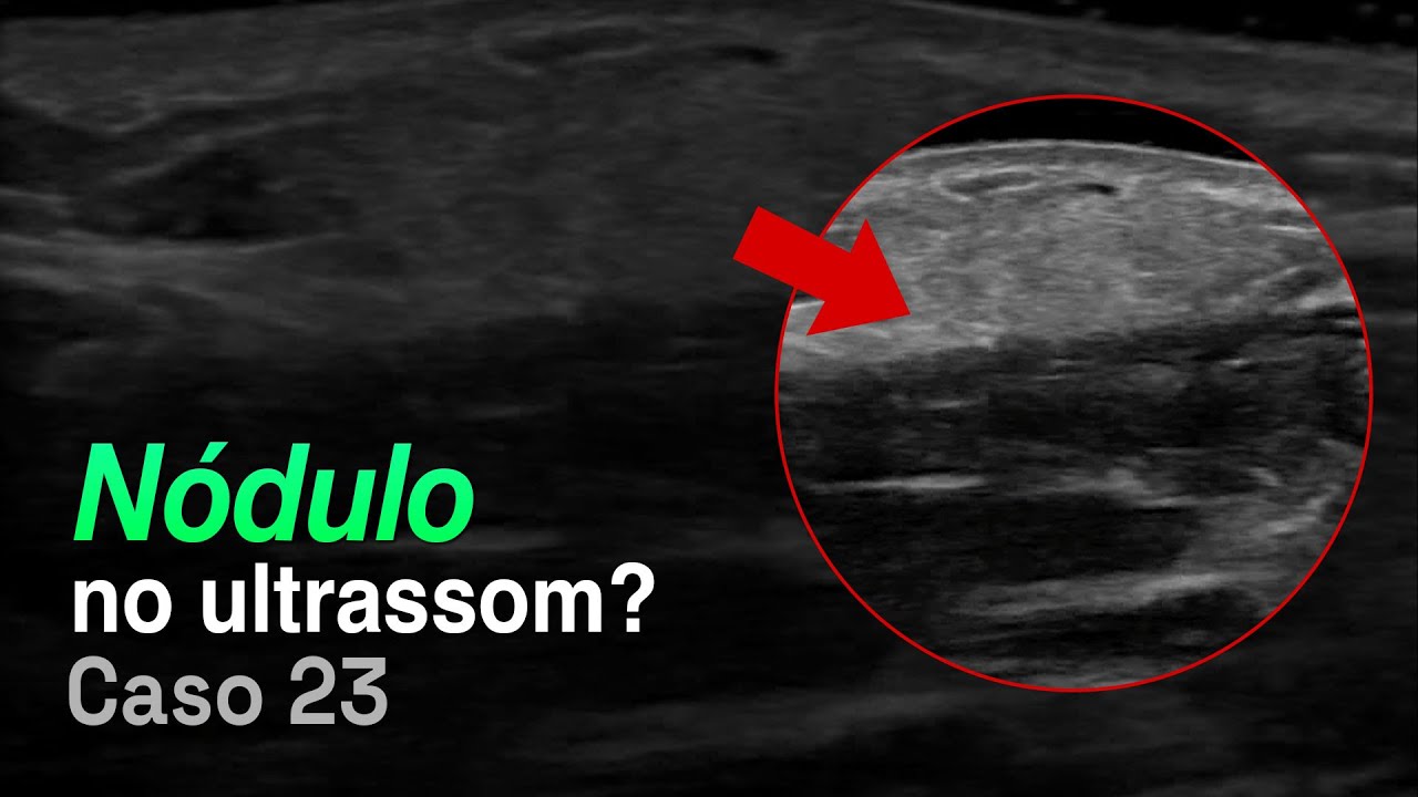 Ultrassom do Antebraço: Nódulo? Veja esse Diagnóstico | Caso 023 - MSKD ...