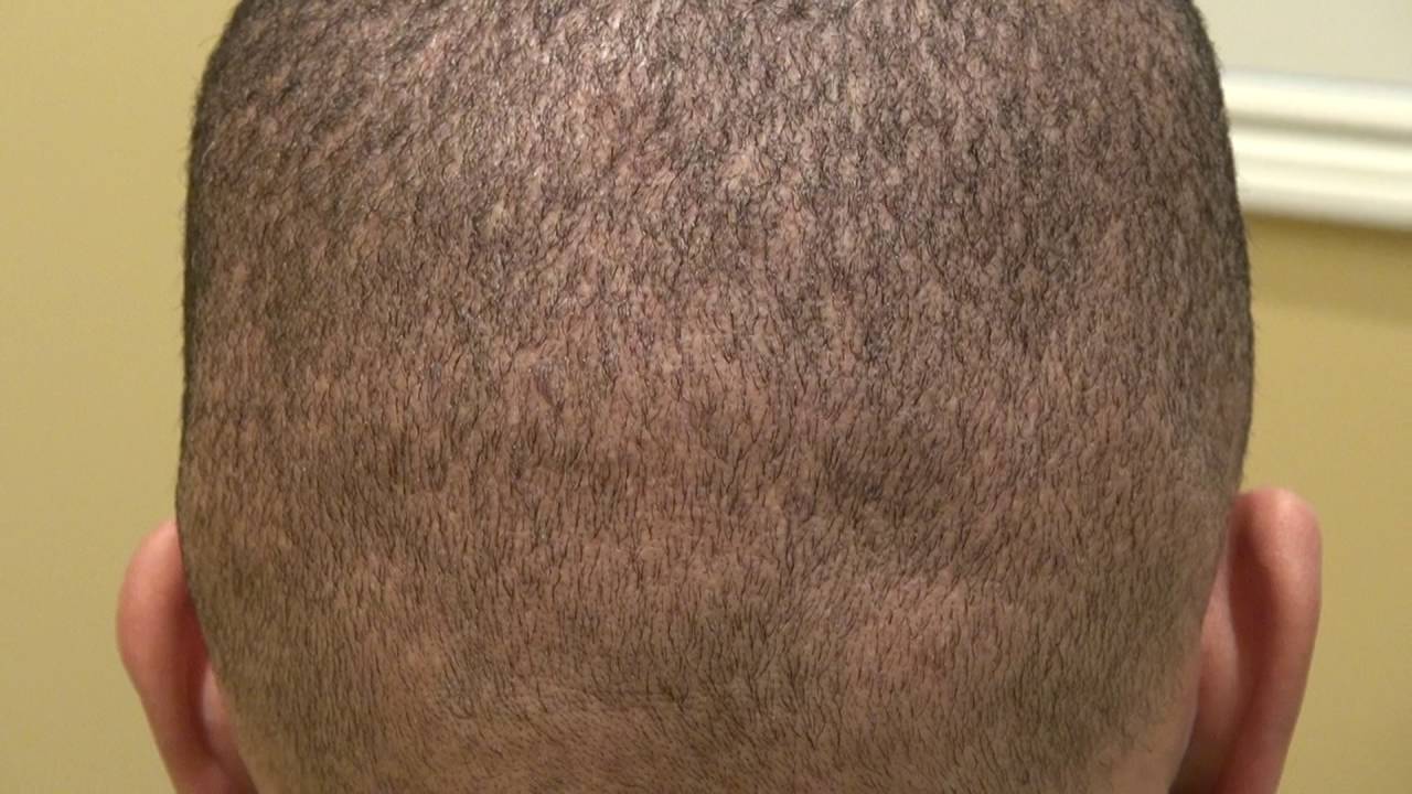 FUE Donor Scar 1 Year Follow Up Mens Hair Loss and Balding Treatment Dr ...