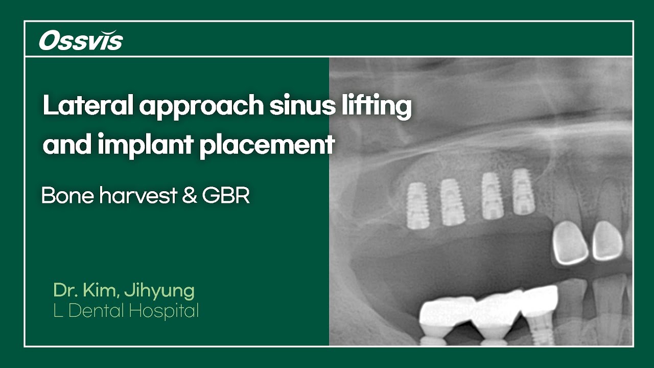 [Clinical Case] Lateral approach sinus lifting and implant placement ...