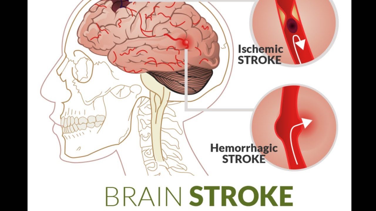 Brain Stroke explained - YouTube