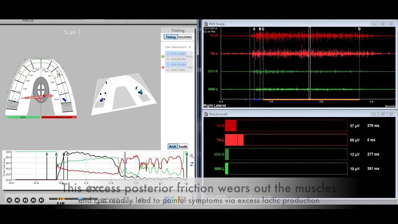 CHRONIC disk displacement WITHOUT REDUCTION-when NOT to DTR! - YouTube