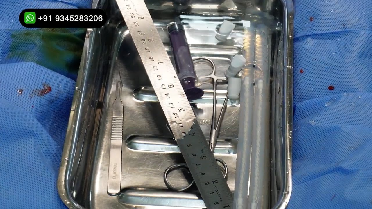 Tube Promedon Penile Implant Surgery | Step-by-Step Procedure - YouTube
