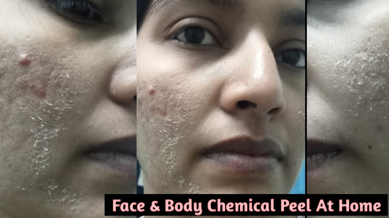 Face & Body Chemical Peel Step By Step || 1 Chemical Peel Multiple Uses ...
