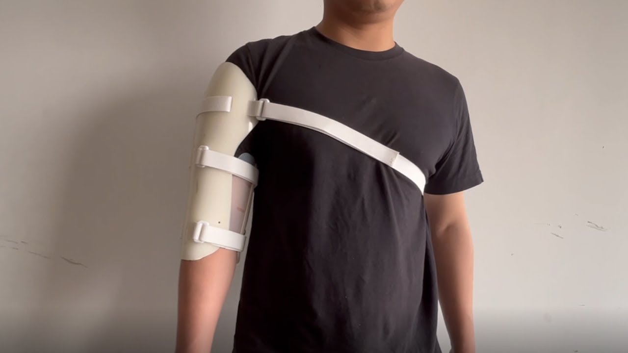 How To Splint A Humerus Fracture At Latanya Boring Blog
