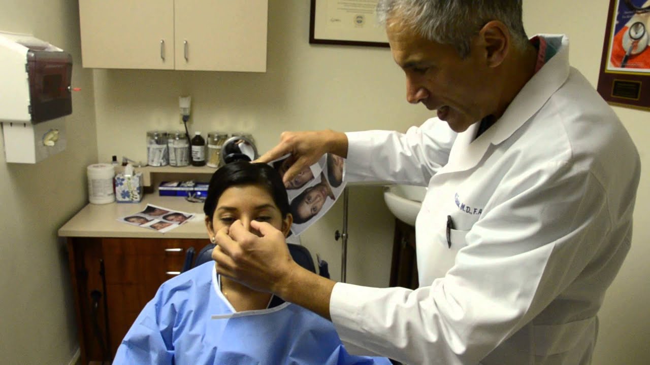 Dr. Epstein - Rhinoplasty Post-Op 10 Days - Achieving a more refined ...