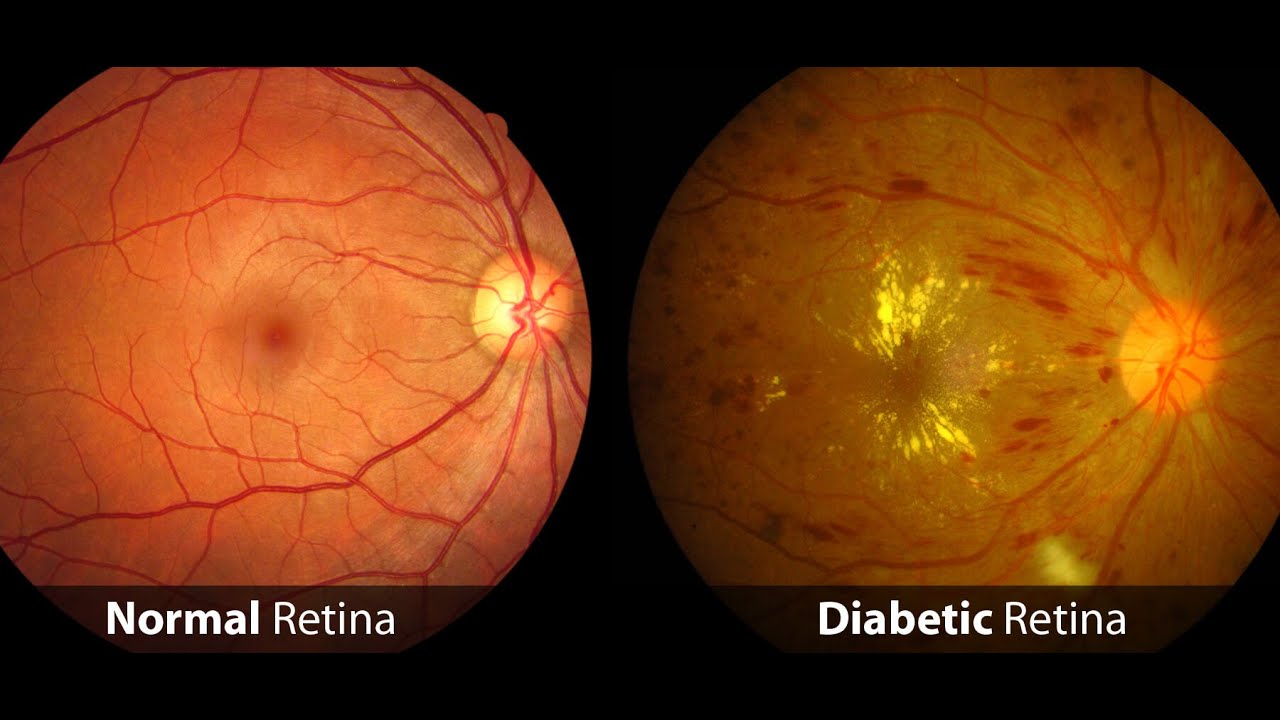 DeepLearning Fundus Image Analysis for Early Detection of Diabetic ...